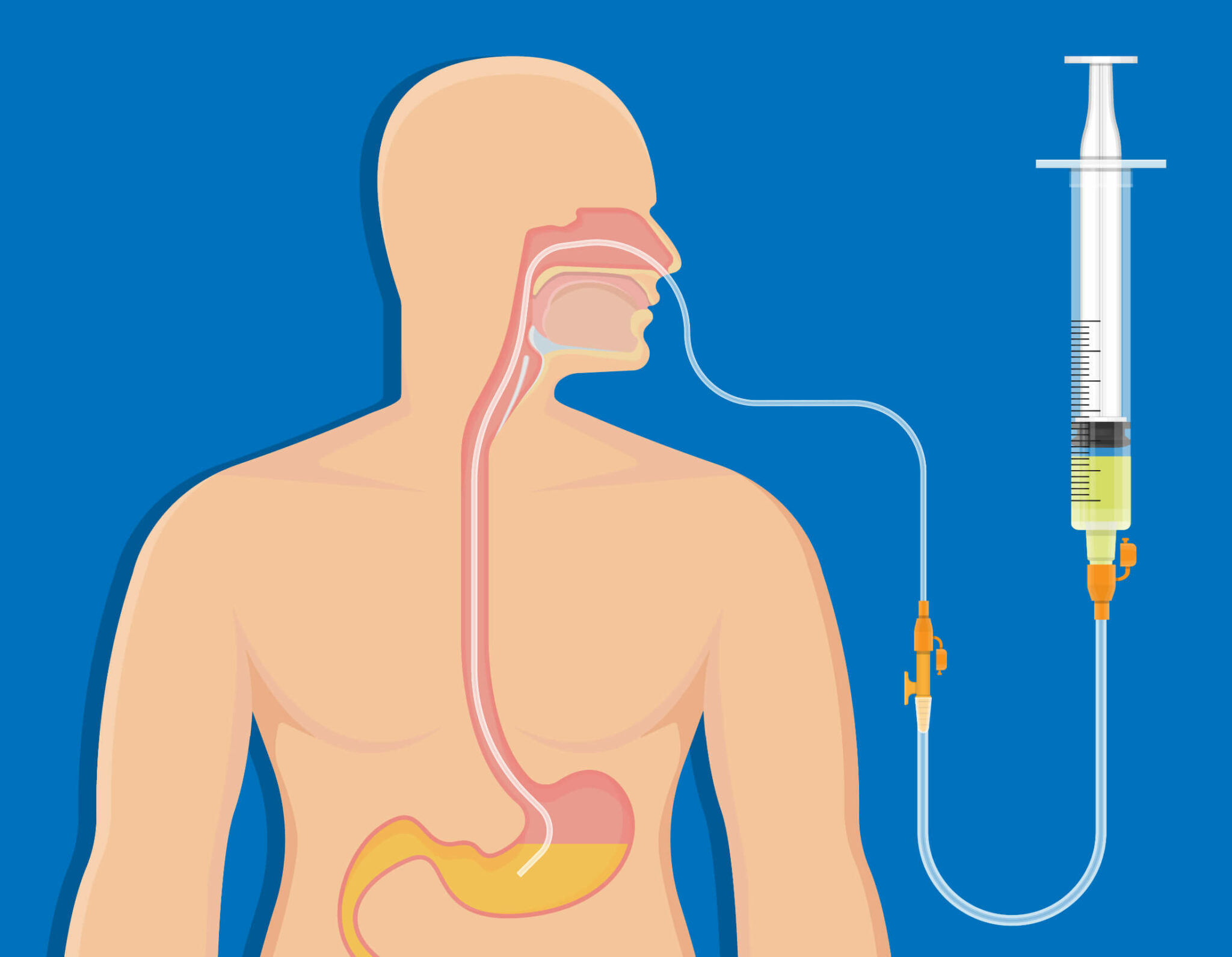 Ingenzas Revolutionary Ph Strips Improve Nasogastric Feeding Tube Placement Ingenza